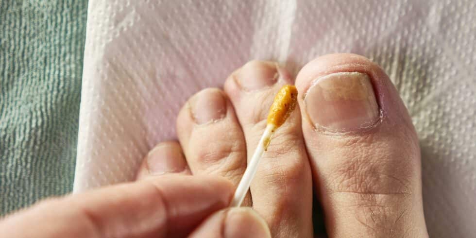 Understanding the Stages of Fungal Nails | Irving Foot & Ankle